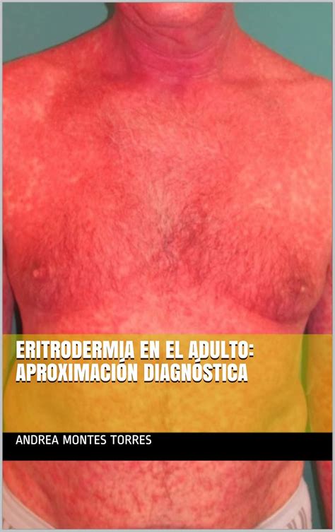 ERITRODERMIA EN EL ADULTO APROXIMACIÓN DIAGNÓSTICA Spanish Edition eBook Montes Torres