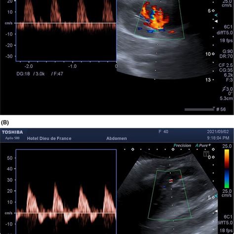 A Patient A A Spectral Waveform Of Intrarenal Arteries Shows A Download Scientific Diagram