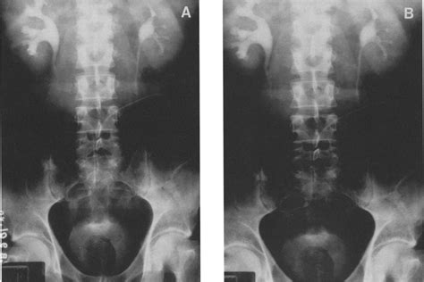 Single Image From An Intravenous Urogram Showing Bilateral Renal Download Scientific Diagram