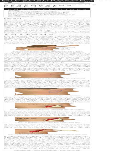 Thoracodorsal Artery Perforator Flap Tap Flap Pdf Human Anatomy Clinical Medicine