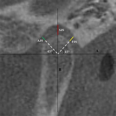 Regions Of Interest On Cbct For Condyle Segmentation Bounded By Broken