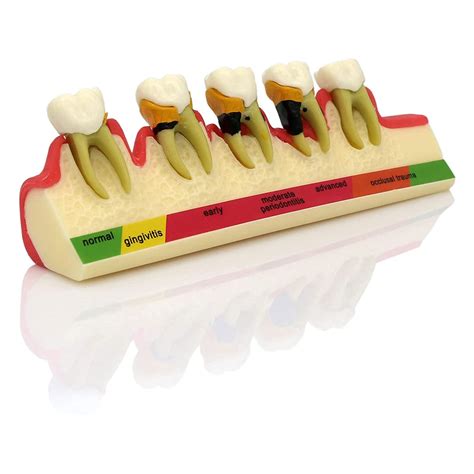 Teeth Periodontal Disease Model Dental Caries Breakdown Display