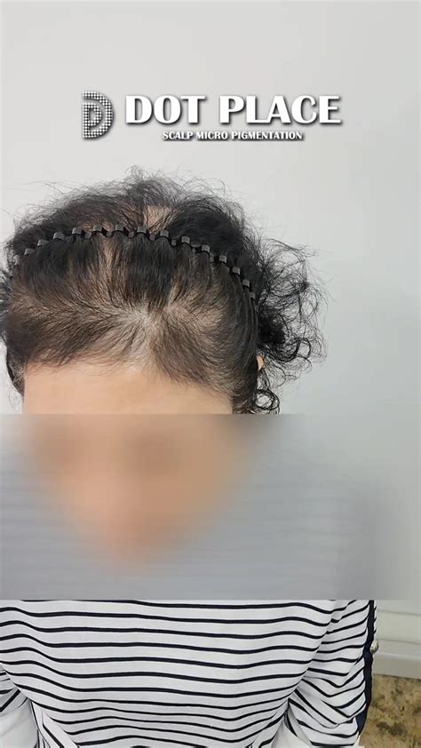 과거 머리때문에 친구들 앞에서도 가발을 쓰며 숨겨왔죠 그러다가 제가 어느날 용기내어 모밍아웃하자 친구 녀석이 저랑 같이 다니면 재밌을 것 같다고 수년째 머리를 기르고