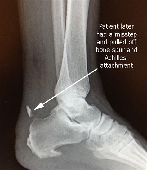 Achilles Tendonitis X Ray