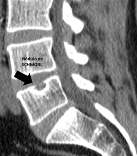 NÓdulo De Schmorl É Perigoso