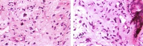 Vietnamese Medic Ultrasound Case 811 Adolescent Phyllodes Tumor Pt