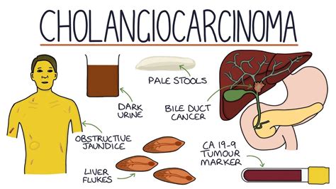 Cholangiocarcinoma Type