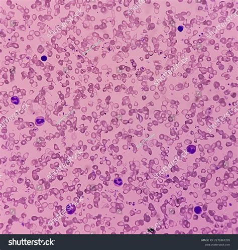 Schistocytes