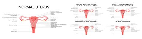 Uterus Images Browse 462 683 Stock Photos Vectors And Video Adobe Stock