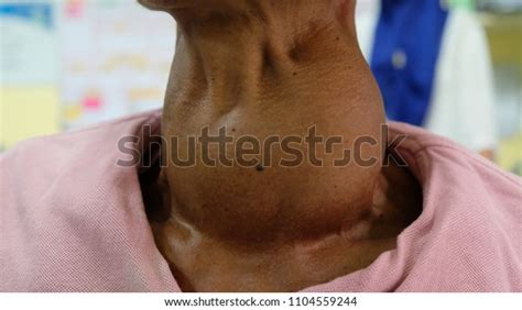 Huge Multinodular Goitre Asian Man Stock Photo Edit Now