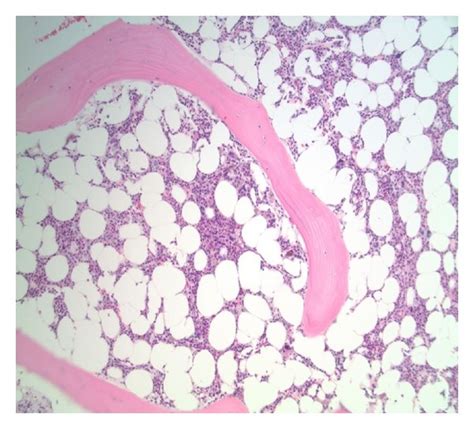 Bone Marrow Showing Hypocellularity And Trilineage Hematopoiesis