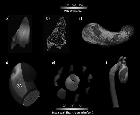 183 Computational Fluid Dynamics A Patient Specific Assessment Of The