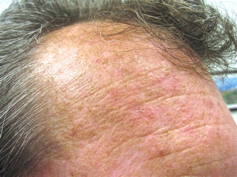 Actinic Keratosis Central Wyoming Skin Clinic