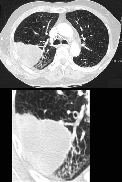 000 Reticular Pattern Reticulation The Common Vein 000 Reticular Pattern Reticulation The Common Vein