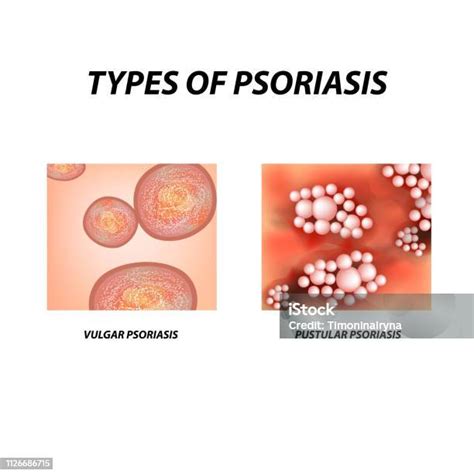 Jenis Psoriasis Bukan Psoriasis Pustular Dan Pustular Eksim Dermatitis Penyakit Kulit Infografis