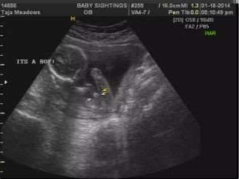 Fetal Age Gender Determination Pptx Pregnancy Reproductive Health