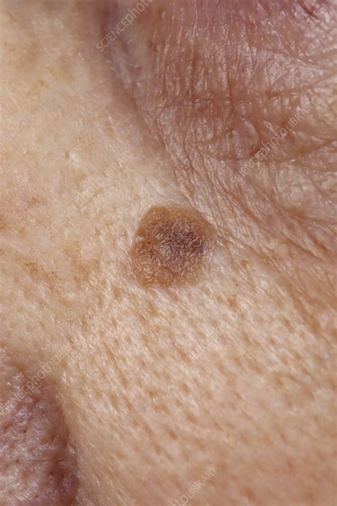 Seborrheic Keratosis Stock Image C0609459 Science Photo Library