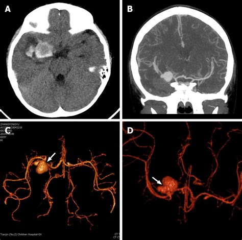 Preoperative Imaging Examination A Subarachnoid Hemorrhage Caused By Download Scientific