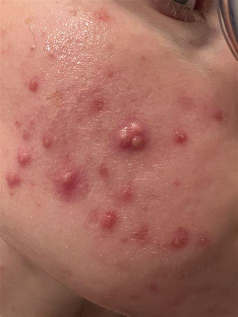 Dont U Just Love Cluster Pimples Lol🥴 Purging Has Done Some Weird
