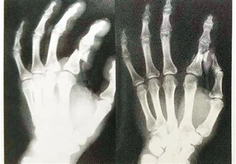 News Do You Know The Fixation Options For Metacarpal And Phalangeal
