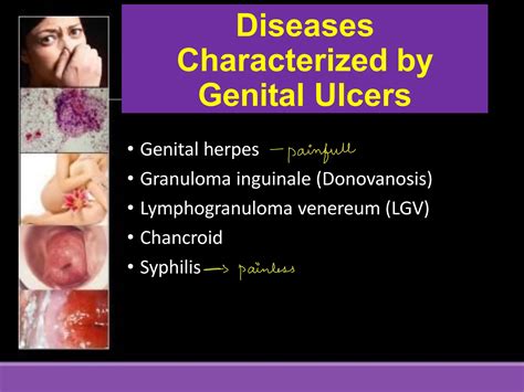 W Pelvic Inflammatory Disease Sexually Transmitted Disease Lecture Pdf Sexual