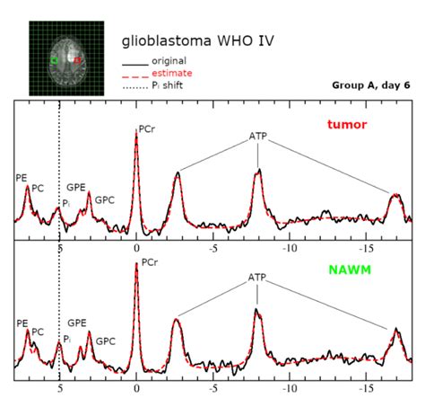 Representative ³¹p Spectra For Tumor Tissue And Nawm At 3t Green