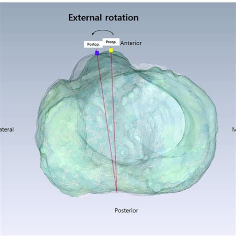 Weight Bearing Line Wbl Joint Line Convergence Angle Jlca Knee