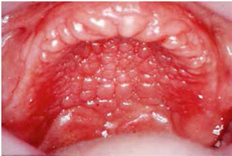 Denture Stomatitis Candida Albicans Figure 3 From Denture Stomatitis