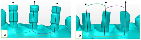 The Influence Of Laboratory Scanner Versus Intra Oral Scanner On Determining Axes And Distances