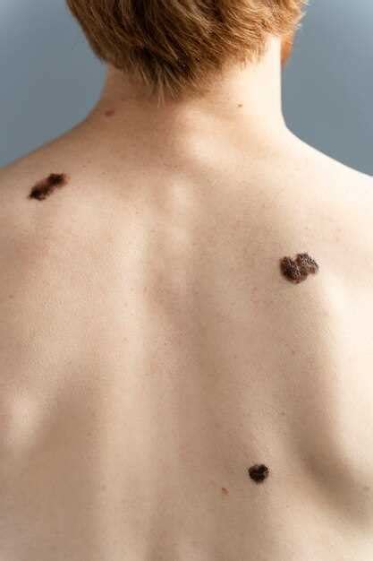 Azithromycin Skin Rash Pictures