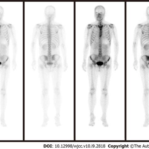 Single Photon Emission Tomography Combined With Computed Tomography Download Scientific Diagram