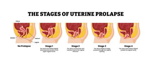 The Stages Of Uterine Prolapse Stages Development Process Labeled