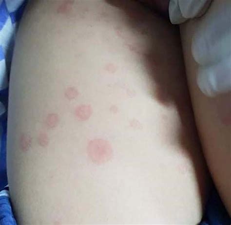 Erythematosus Rash On The Right Thigh With Mildly Elevated Borders Download Scientific Diagram