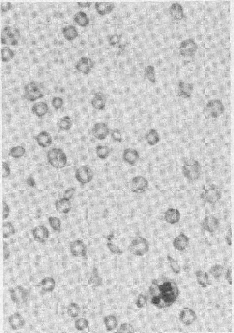 Hemosiderinuria Semantic Scholar