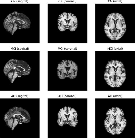 Enhancing Mri Based Classification Of Alzheimers Disease With Explainable 3d Hybrid Compact