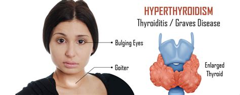 Hyperthyroidism In Women Hyperthyroidism In Women Dubai Uae