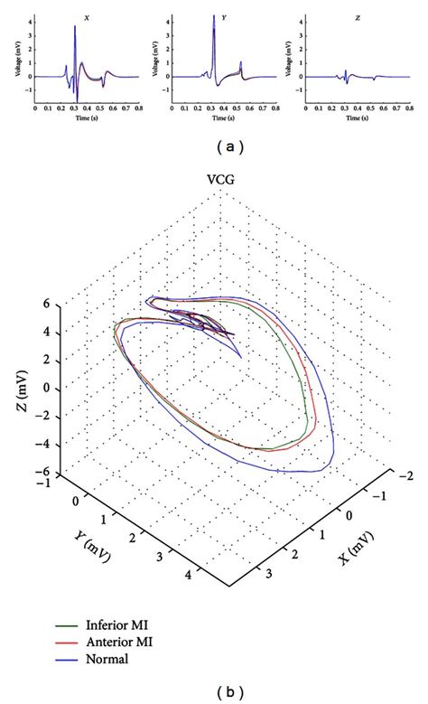 vectorcardiogram at collection of vectorcardiogram