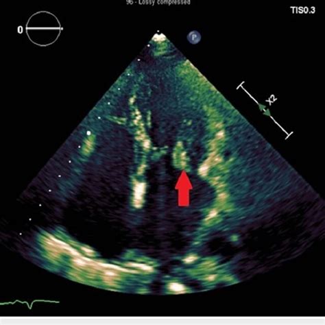 Mitral Valve Vegetation On The Posterior Leaflet Seen In The Apical