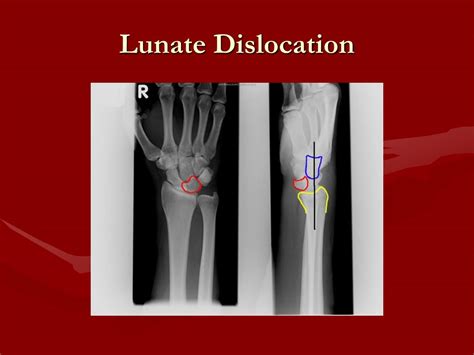 Ppt Wrist And Hand Injuries Powerpoint Presentation Free Download