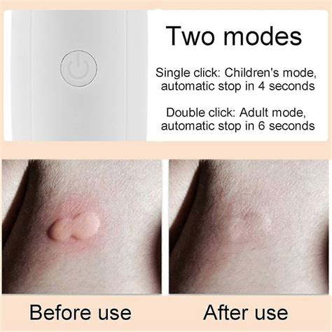 Electric Insect Bite Healer Insect Bite Healer For Mosquito Stings And Bites Insect Bite Electric Insect Bite Healer Insect Bite Healer For Mosquito Stings And Bites Insect Bite