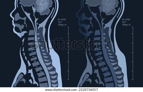 Mri Cervical Spine Without Contrast Mri Stock Vector Royalty Free 2228736057 Shutterstock