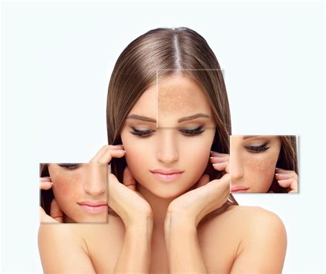 Post Inflammatory Hyperpigmentation Explained How It Happens And How