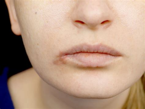 Candida Skin Face
