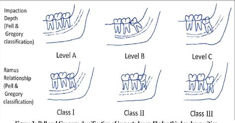 Figure 2 From Classification Of Impacted Mandibular Third Molars In A Sample Of The Saudi