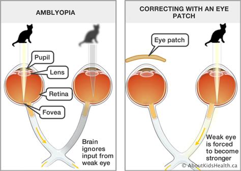 How To Fix Lazy Eye Amblyopia Evershine Optical