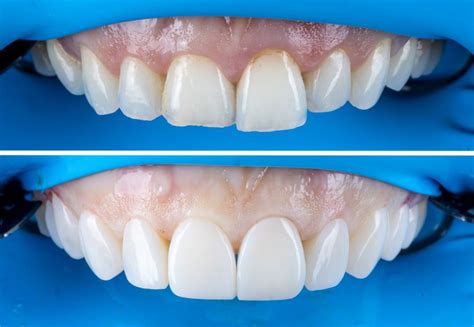 Monoshade Composite Bonding