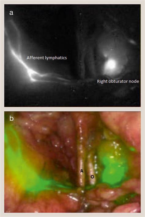 Endometrial Cancer An Update On Diagnosis Treatment And The Role Of