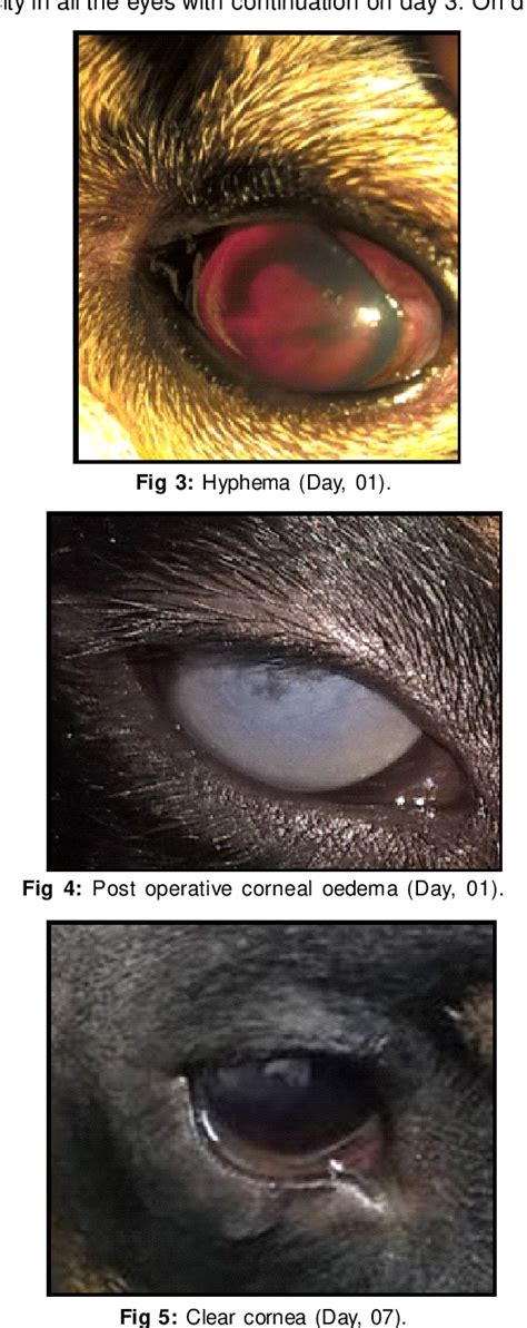 Figure 4 From Postoperative Complications After Phacoemulsification And