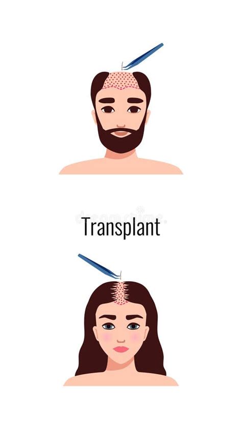 Alopecia Transplant Heads Composition Stock Vector Illustration Of