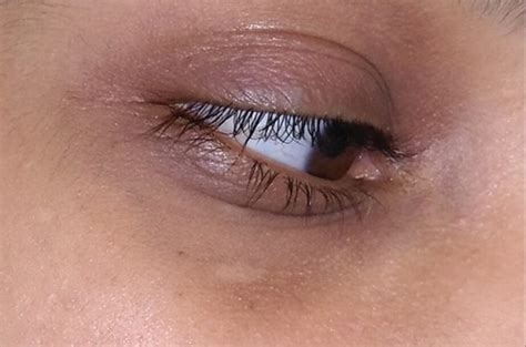 Scalp Biopsies Everything You Need To Know To Diagnose Hair Loss